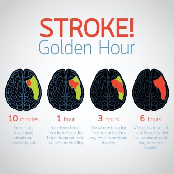 8 Important Facts You Need to Know About Stroke - 8List.ph
