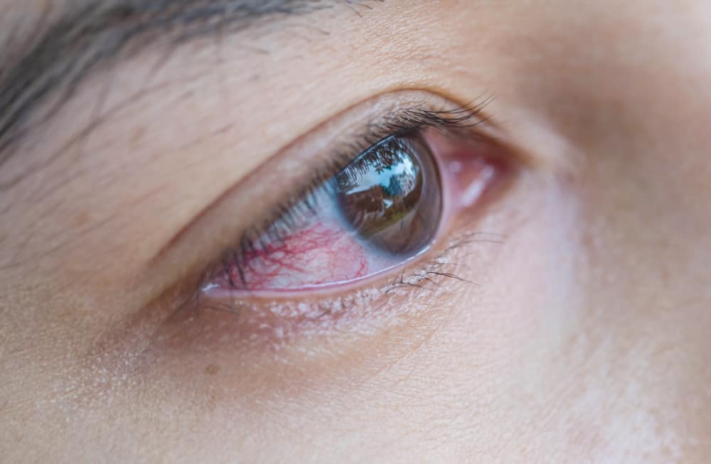 PSA: Stop Rubbing Your Eyes! Here’s Why You Should Break This Bad Habit ...